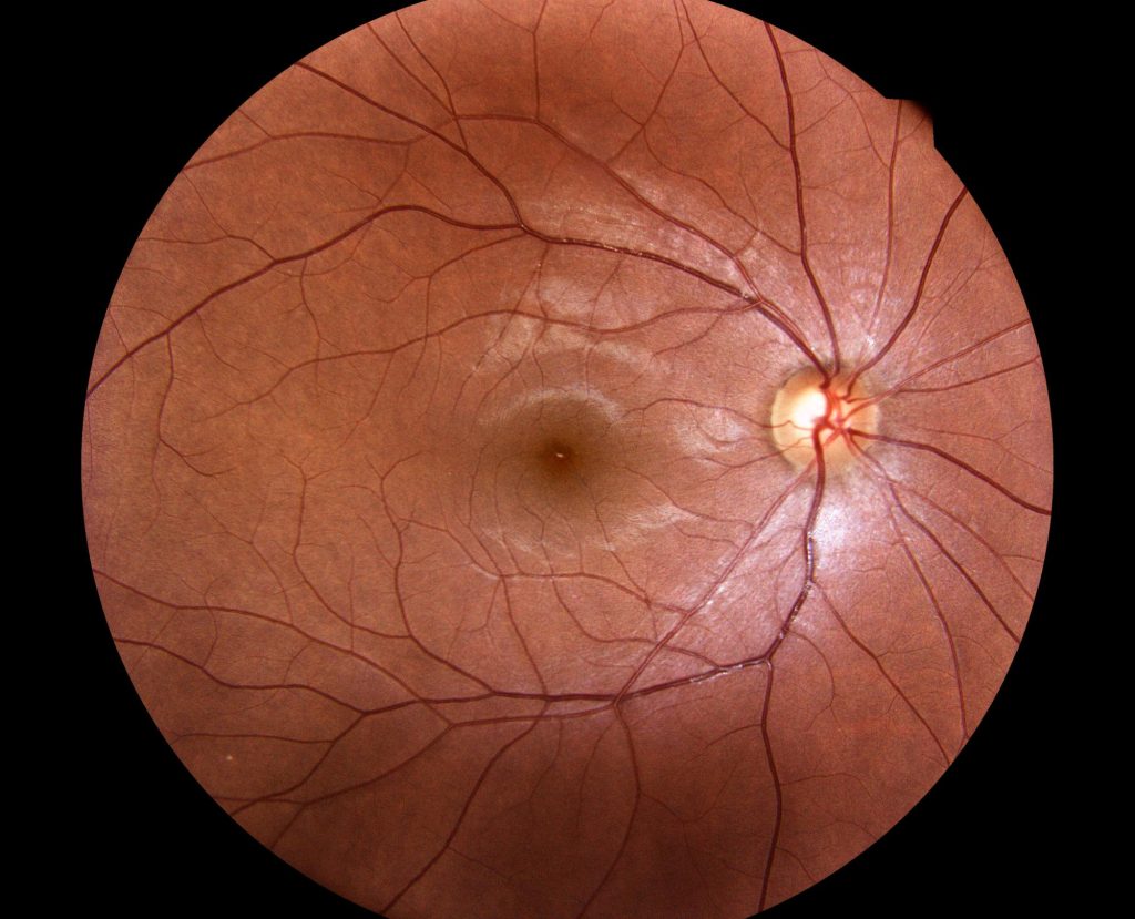Diabetic Retinal Photography – Diabetes Singapore